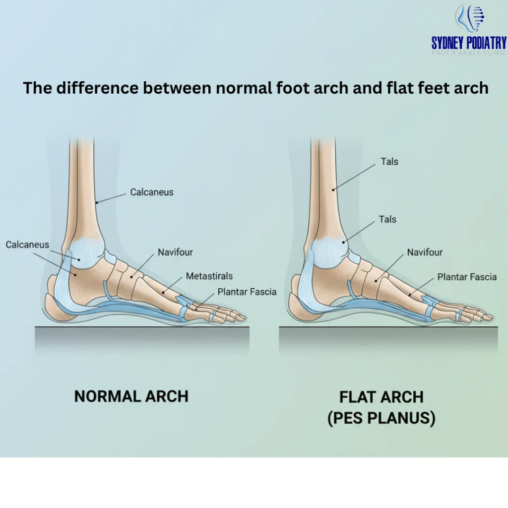 Flat Feet Treatment: Causes, Symptoms, Exercises & Remedies (2025)